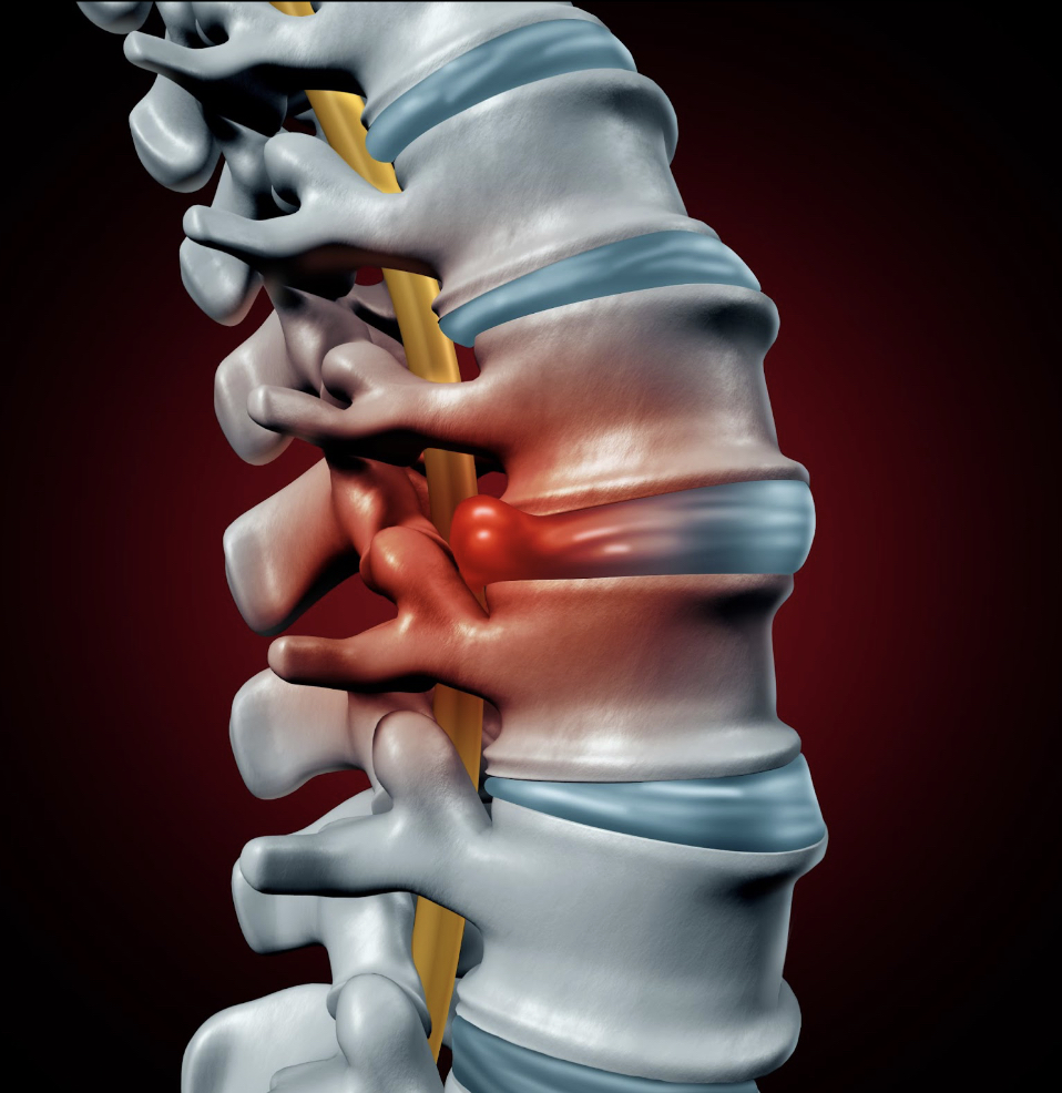 Bulging Disc Diagnosis – Overview And Treatment | BEST