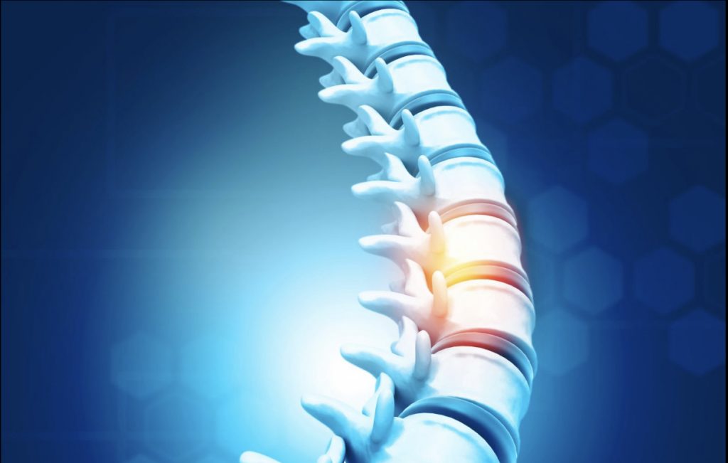 Five Things You Need To Know About Collapsed Disc Treatment – BEST ...