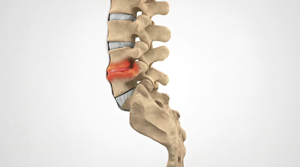 Facet Syndrome - Learn About The Symptoms And Treatment Options | BEST