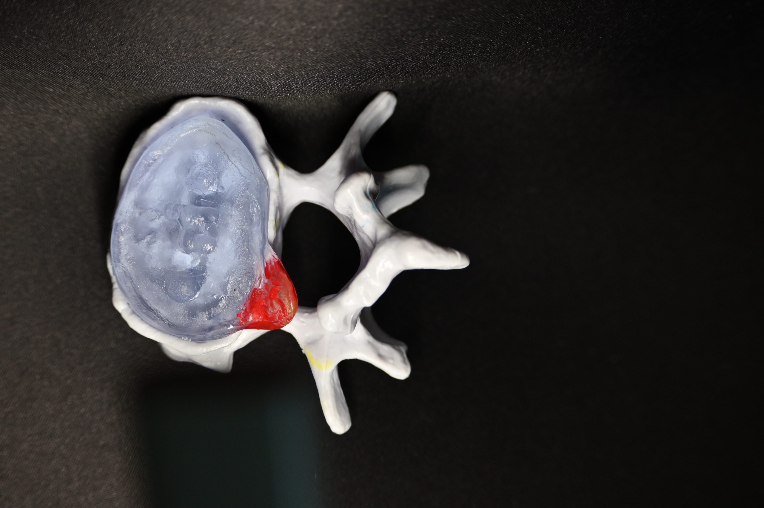 Disc Protrusion and Extrusion - Six Differences | BEST Health System